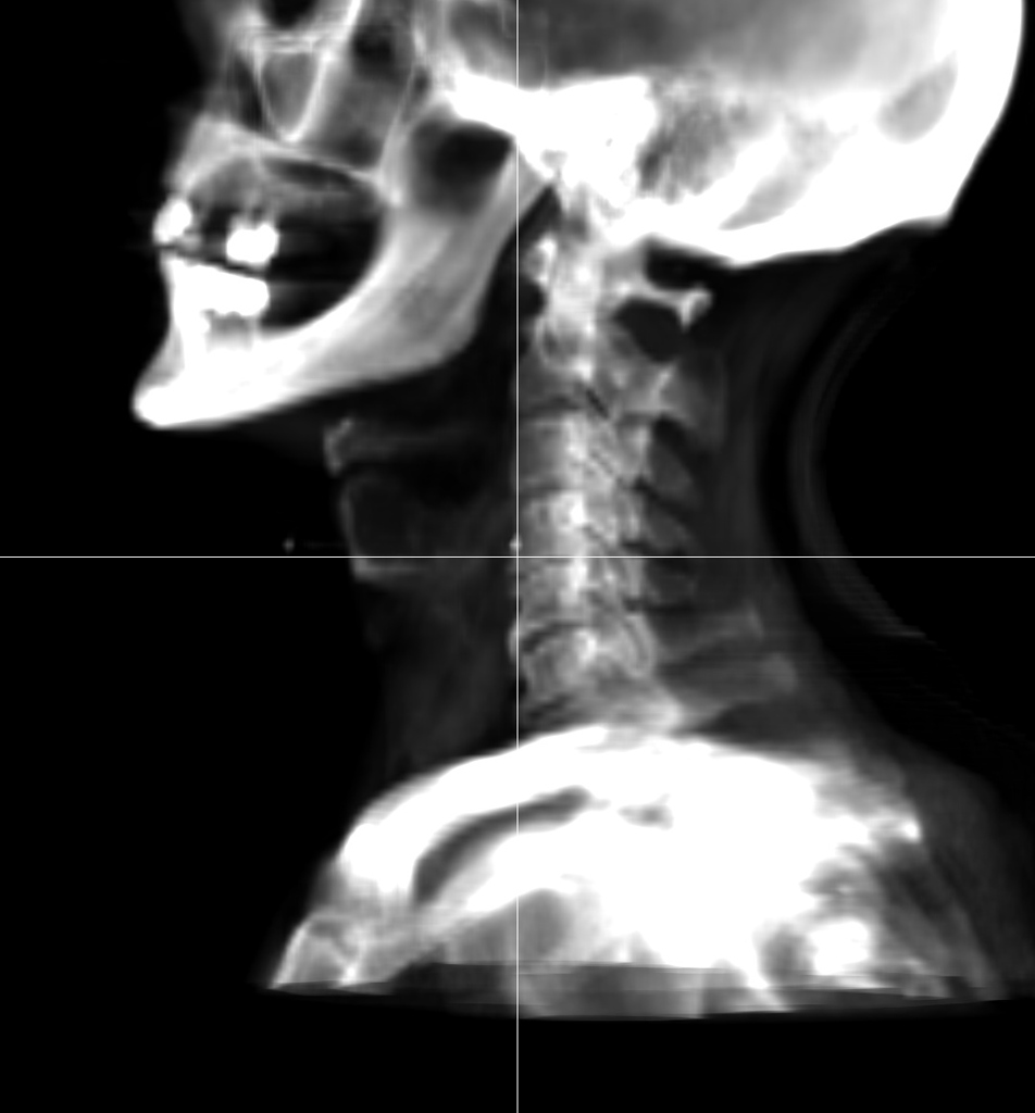 ITK to RTK migration, forward projection issues/questions - Algorithms - ITK
