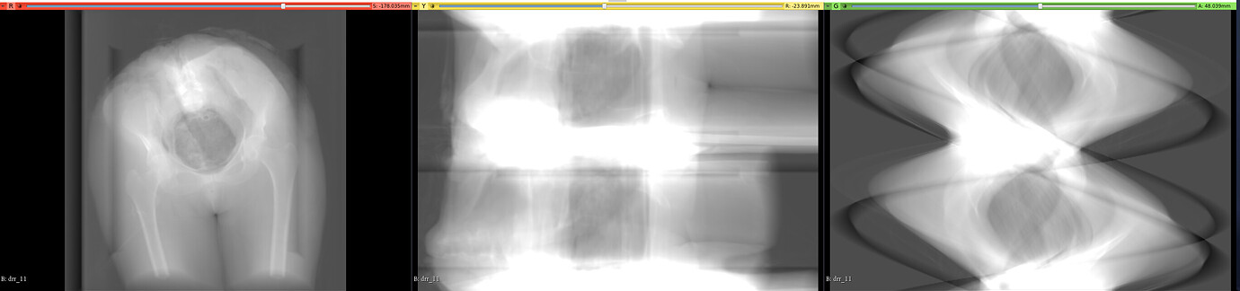 Creating Digitally Reconstructed Radiographs from Chest CT - Beginner ...