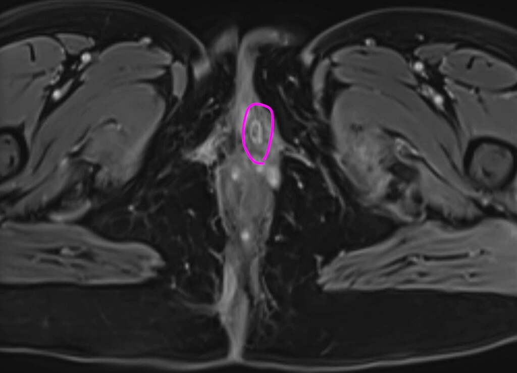 Segmenting Non-Vascular Tubular Structures in MRI - Algorithms - ITK