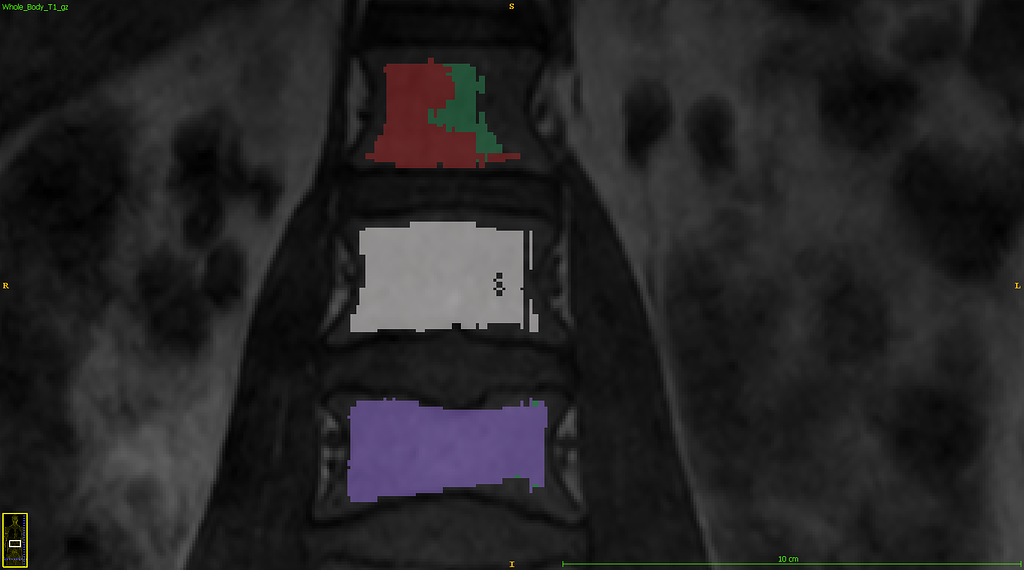 Remove Multiple Labels In 1 Bone And Have Only 1 Label Per Bone Python Itk